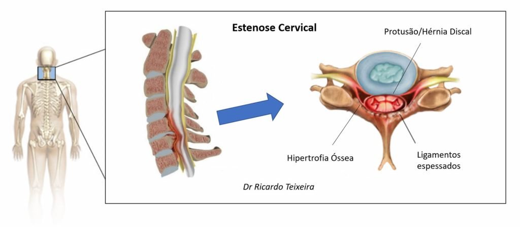 Estenose Cervical: Quais são suas causas e sintomas?