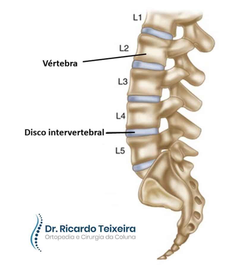 Fissura do Ânulo Fibroso - Dr. Ricardo Teixeira