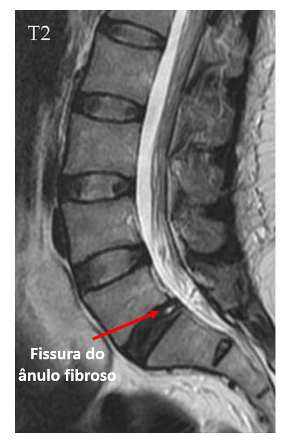 Fissura do Ânulo Fibroso - Dr. Ricardo Teixeira