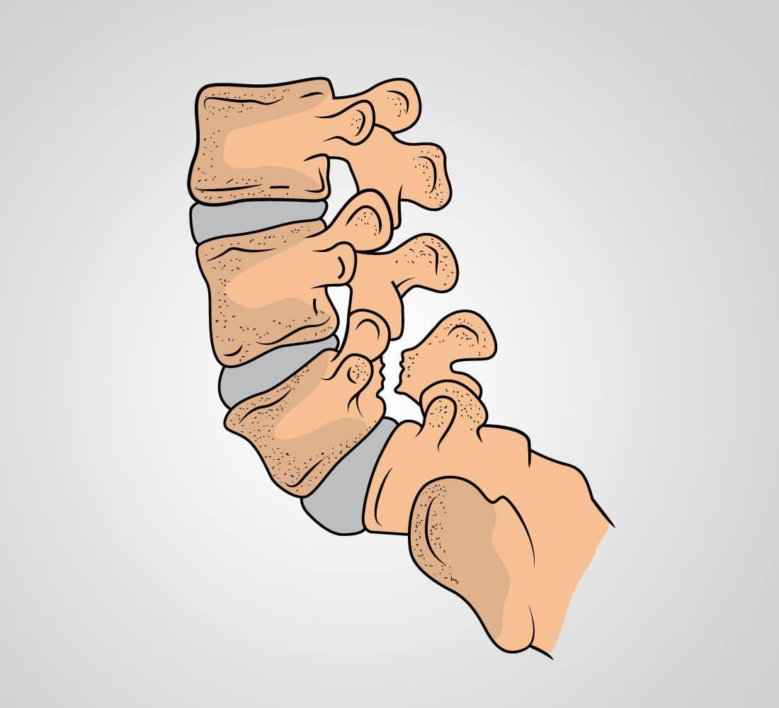 Espondilólise ou Lise dos Istmos - Dr. Ricardo Teixeira