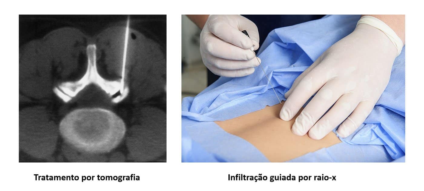 Quais as principais formas de tratamento do Cisto de Coluna?