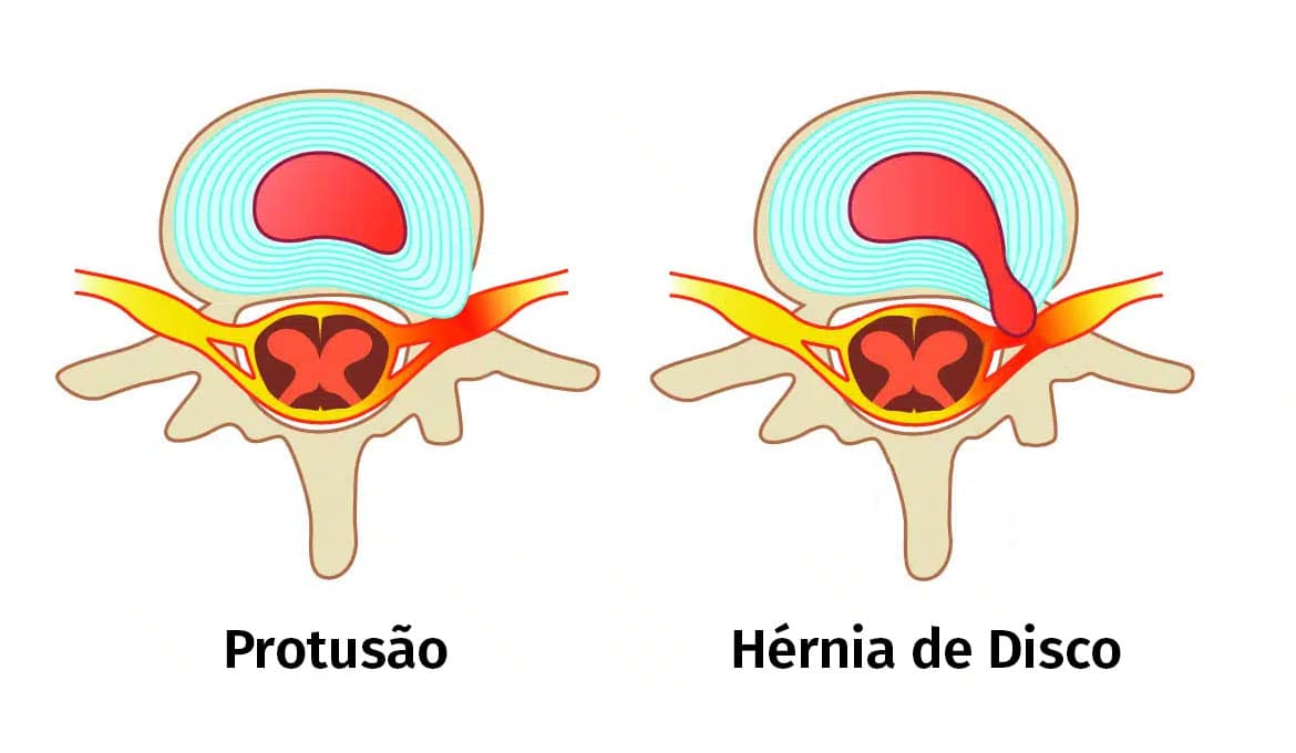 Protrusão Discal: o que é e qual a chance de reversão
